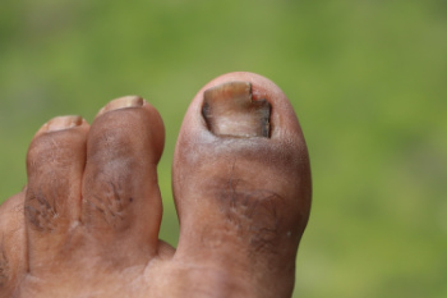 How Athletes Can Tackle Toenail Fungus